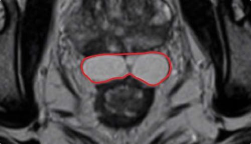 Types of Hydrogel Spacers for Prostate Cancer Radiation