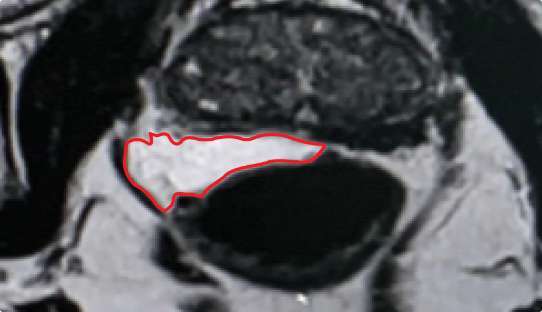 Types of Hydrogel Spacers for Prostate Cancer Radiation