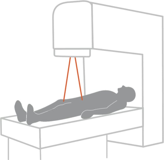 Radiation Treatment for Prostate Cancer: Know Your Options | Barrigel